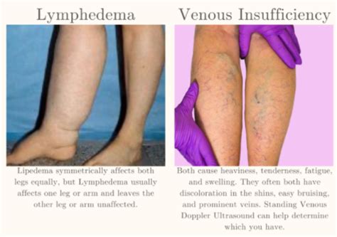 Understanding Lipedema And Veinous Insufficiency St Louis Laser Vein