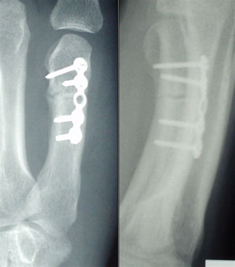 The Correction Obtained With Closing Wedge Osteotomy Download Scientific Diagram