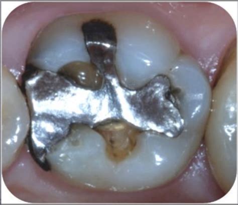 Dentistry Year 2 Lecture Dental Amalgam Flashcards Quizlet