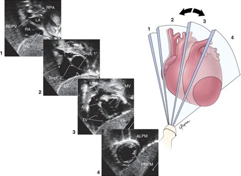 4 The Normal Pediatric Echocardiogram Veterian Key