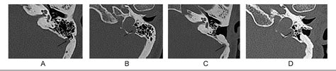 Figure 1 From Transmastoid Hydroxyapatite Resurfacing For Sigmoid Sinus Wall Anomalies Causing