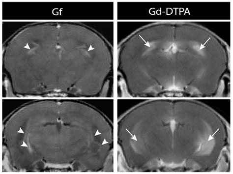 Early Gf Enhancement Of The Choroid Plexus Coronal T1 Weighted Images