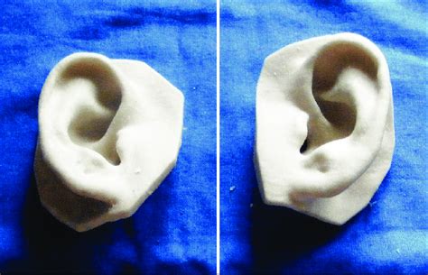 Polymer Model Fabricated For Bilateral Defect By Rapid Prototyping