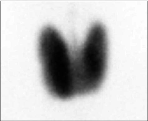 Patients Scintigraphy Scan This Shows Diffuse Enlargement Of Both