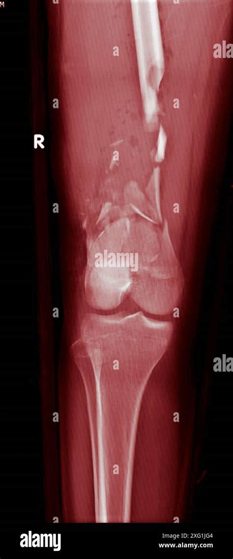Coloured X Ray Of A Comminuted Femur Thigh Bone Fracture This Is A Type Of Fracture In Which