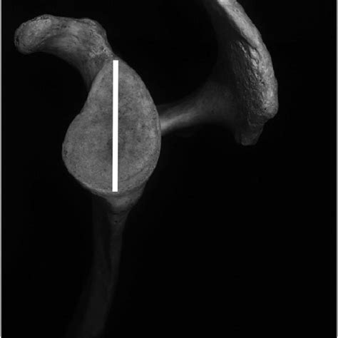 Breadth Of The Glenoid Cavity Measurement As Described In Table 1