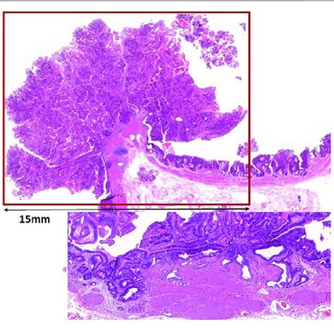 Low Magnification Picture Of The Polypoid Mass Protruding From The Download Scientific