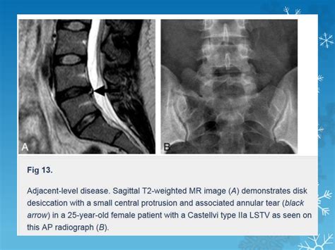 Transitional Vertebrae Radiology