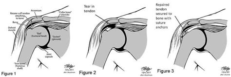 Failed Rotator Cuff Repairs Johns Hopkins Medicine