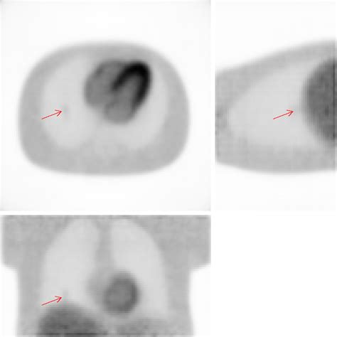 Comparison Of The Uncorrected Image And The Motion Corrected One Here