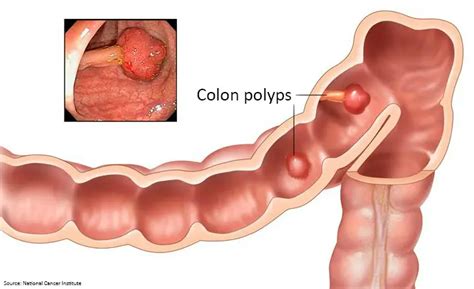 Colonoscopy Polyps Biopsy