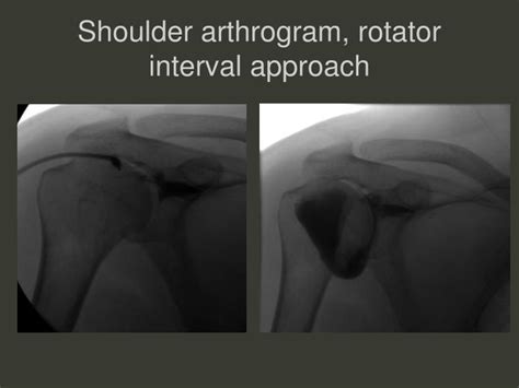 Ppt Anatomy And Pathology Of The Rotator Interval Powerpoint