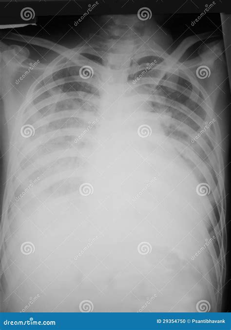 Chest Film Antero Posterior Ap View Of A 32 Years Old Man Demonstrated Cardiac Enlargement