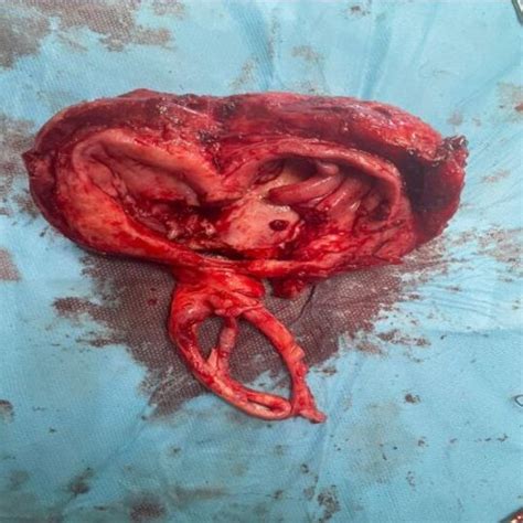 Photography Of The Excised Inverted Uterus Sent To Pathology Download Scientific Diagram