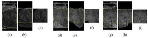 Hybrid Classification Of Diffuse Liver Diseases In Ultrasound Images Using Deep Convolutional
