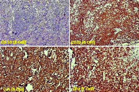 Photomicrograph Showing Strongly Positive Ihc Staining For Both B Cell Download Scientific