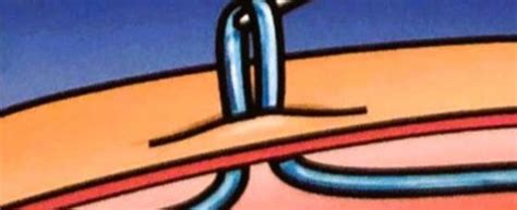 Vein Surgery Dublin Vein Clinic