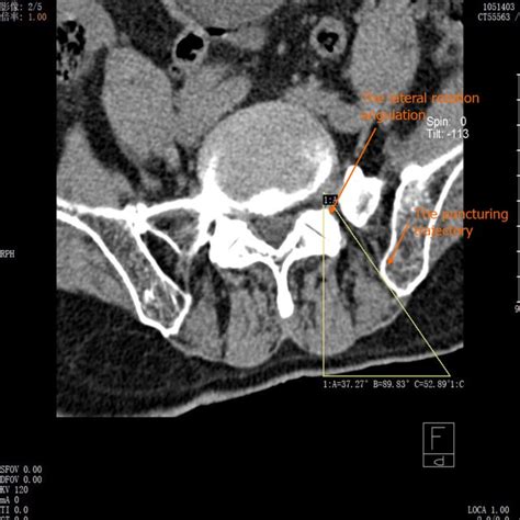 Proper Trajectory Angle Measured In Computed Tomography Scan For This Download Scientific