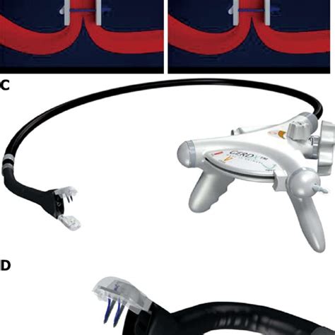 Pdf Endoscopic Full Thickness Resection Current Status