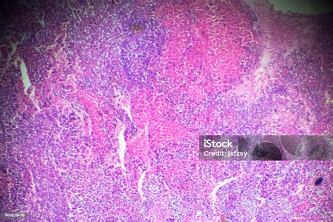 Acute Phlegmonous Appendicitis Pathology Under Light Microscopy Stock