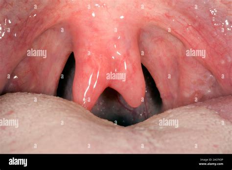 Bifid Cleft Or Split Uvula At The Back Of The Mouth This Is A Minor