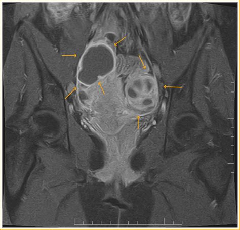 Adnexal Masses Mri Evaluation Sumers Radiology Blog