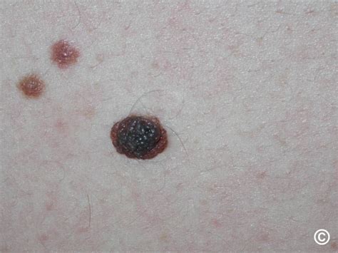 Intradermal Nevus Symptoms Causes And Treatments