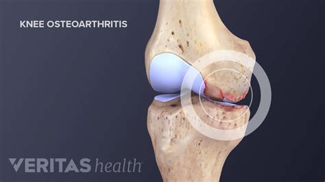 Knee Osteoarthritis