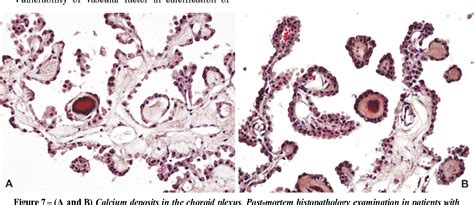 Choroid Plexus Calcification Clinical Neuroimaging And Histopathological Correlations In