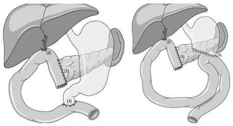 Pylorus Preserving Whipple Procedure