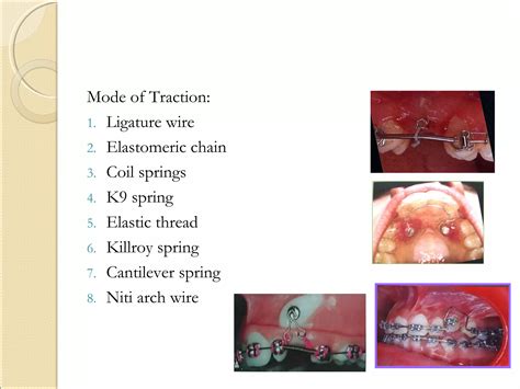 Leveling And Aligning In Orthodontics Ppt