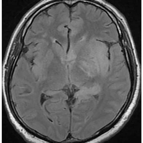 Mr Dw Image Done At Admission Showing Diffusion Restriction Involving