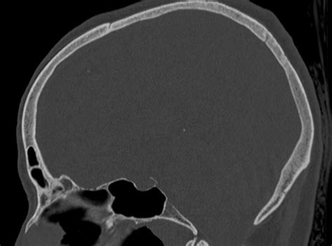 Diffuse Dural Calcification Image