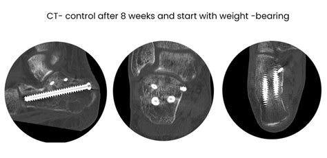 Calcaneal Fracture Both Sides Tongue Minimal Invasive Treatment Of
