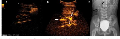Figure From Comparison Of Voiding Cystourethrography And Urosonography With Second Generation