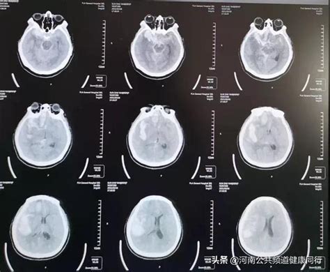 这是一颗“不定时炸弹”，它和明天不知道谁先到来——颅内动脉瘤破裂的一些事儿心脑血管频道东方养生