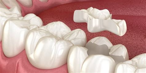 Rct Teeth Cap Prices In India A Comprehensive Guide