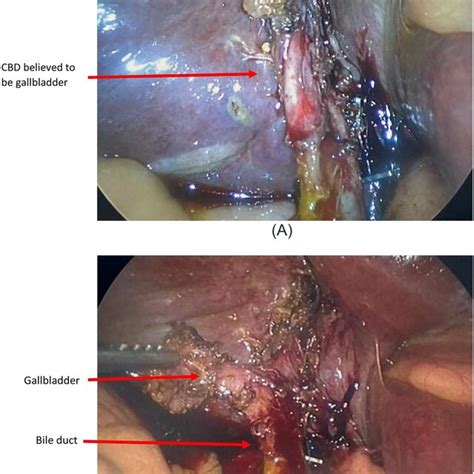 Intraoperative Cholangiogram Download Scientific Diagram