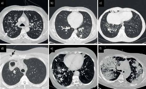 A Chest Computed Tomography Ct Of A Patient With Streptococcus Download Scientific Diagram