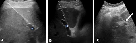 Interventional Management Of Acquired Lymphatic Disorders Radiographics