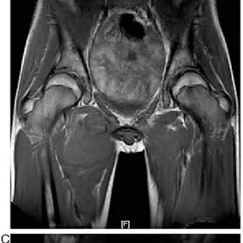 Osteosarcoma In A Female Patient Aged Years Osteosarcoma Of Left Download Scientific
