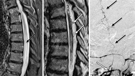 Spinal Vascular Malformations Cohen Collection Volumes The