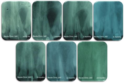 Radiographic Evaluation Of A Successful Clinical Case Download