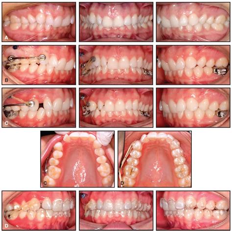 Aligner La Classe Spark Clear Aligners Doctor Site Innovative