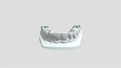 Mda Mini Distalizing Appliance 3d Model By Odl Ortholab Odlortho