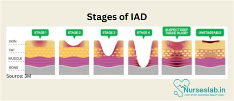 What Is Incontinence Associated Dermatitis Iad How To Manage It