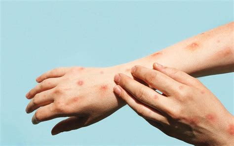 Kenali Gejala Monkeypox Dan Cara Mencegahnya Sideid