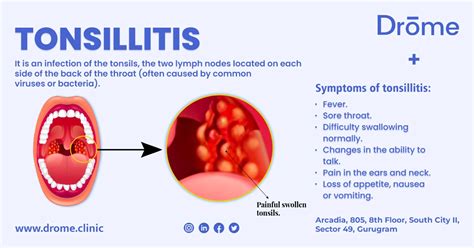Tonsillitis Causes Symptoms And Effective Treatments