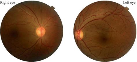 Fundus Photography At Presentation Showing Macular Lesion Simulating