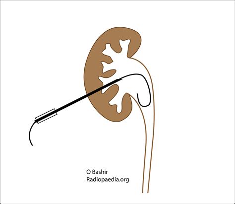 Percutaneous Nephrostomy